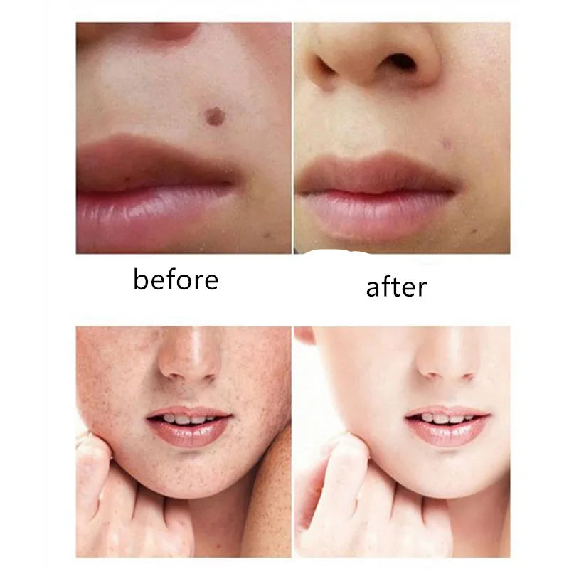 Mole Remover Device Pen – Mask Queen Nepal